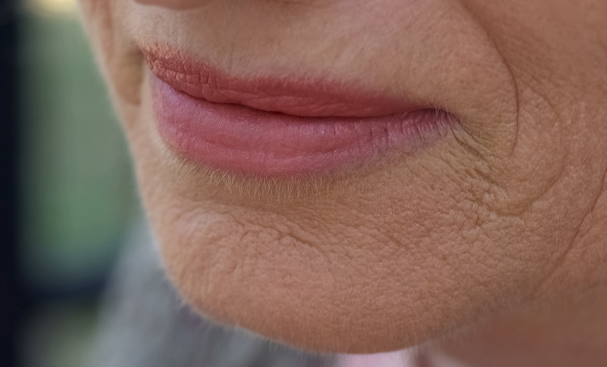 Chin Dimples - DL Aesthetics